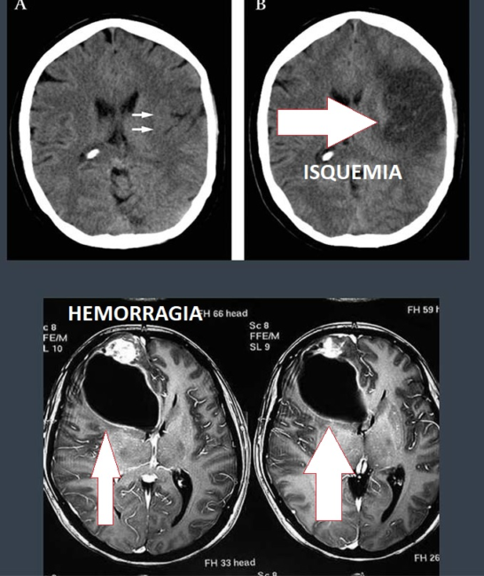 Derrame e infarto cerebral: ¿Qué nos dice la evidencia científica ...
