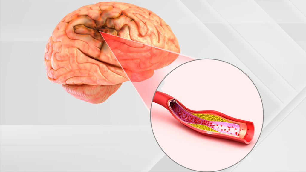 Sintomas isquemia cerebral - Neurocognitive Academy